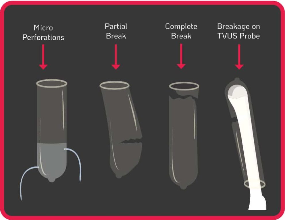 The Importance of High-Level Disinfection on Transvaginal Ultrasound ...
